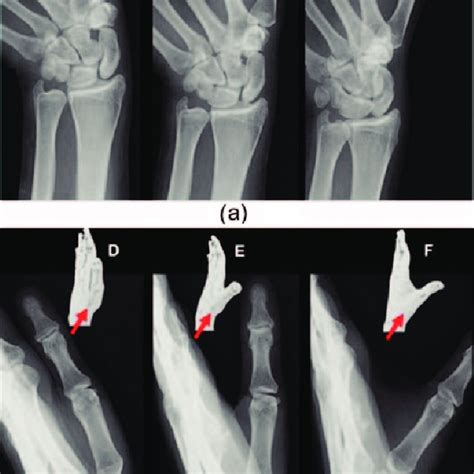 Pdf Fractures And Dislocation Of The Base Of The Thumb Metacarpal
