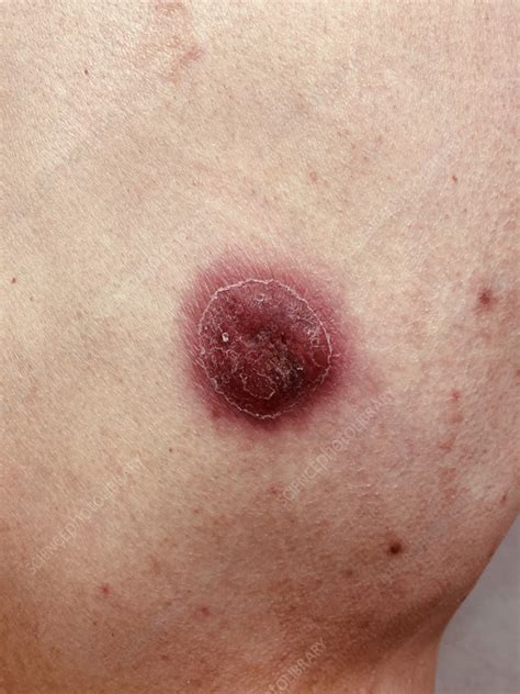 Pyoderma Gangrenosum After Diverticulitis Surgery Stock Image C056 0533 Science Photo Library