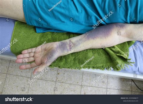 Hematoma After Surgery Should Anything Be Done For A Large Hematoma