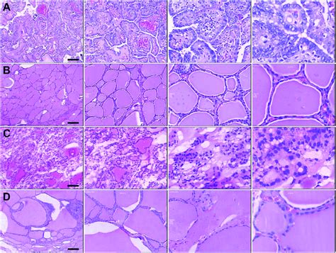 Immunohistochemical Staining Of Thyroid Specimens Representative