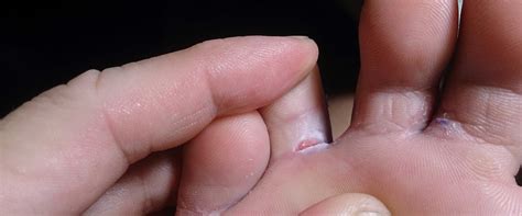Burning Cracked Skin What Is Athletes Foot Fungus Between The Toes