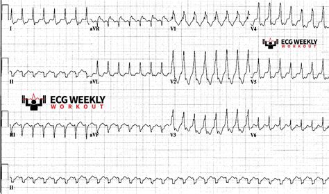 Wide Complex Tachycardias Can ECG Algorithms Safely Rule Out Ventricular Tachycardia In The