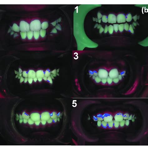 A Fluorescent Plaque Index Fpi Analysis Using Propriety Software Of