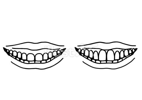 Free Vectors Gummy Smile And Gingivectomy Comparison Line Drawing