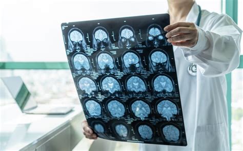 Encefalitis necrotizante multifocal y miocarditis tras la vacunación