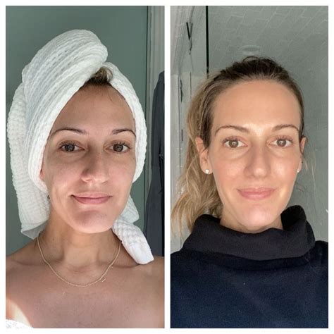 Tretinoin Before And After Acne