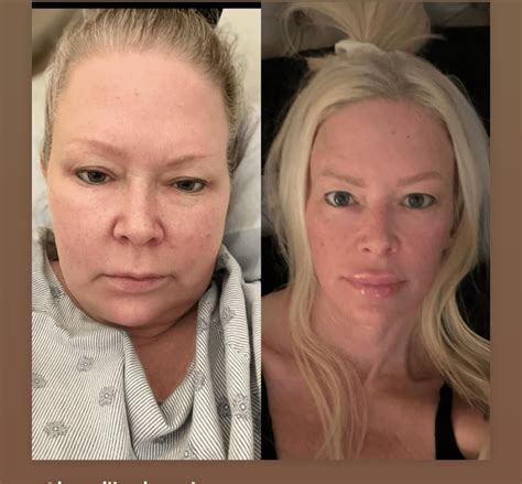 It Was Alcohol Bloat Not Prednisone Liar Rwtfjennajameson