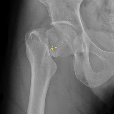 Impacted Fracture X Ray