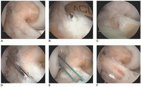 Revision Acl Reconstruction Musculoskeletal Key