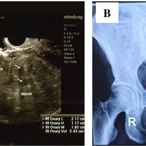 Radiology Examination Of The Patient A Transvaginal Sonogram Showed