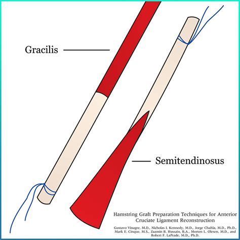 How Do You Harvest And Prepare Hamstring Tendon Autografts For Acl