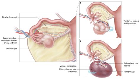 Ovarian Cysts How Do They Cause Miscarriage Antai 52 Off