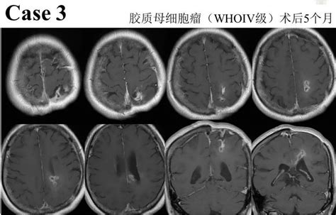 Mr图谱 放射性脑损伤vs胶质瘤复发 Inc国际神经外科医生集团
