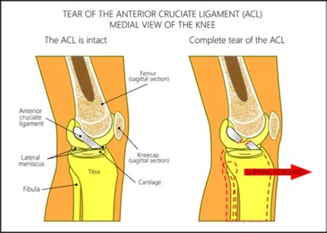 Torn Acl And Meniscus