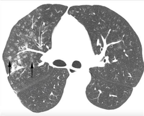 000 Micronodules Lungs