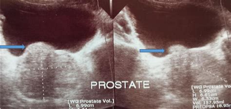 Median Lobe Prostate