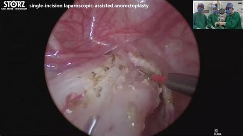 Live Surgery 2 Single Incision Laparoscopic Assisted Anorectoplasty