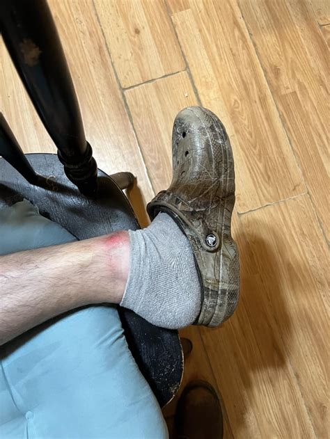 Trimalleolar Dislocation Rbrokenbones