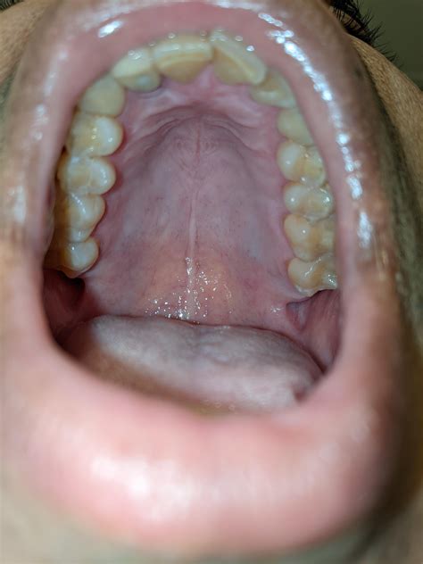 Bumps On Mouth Roof Rdentalhygiene