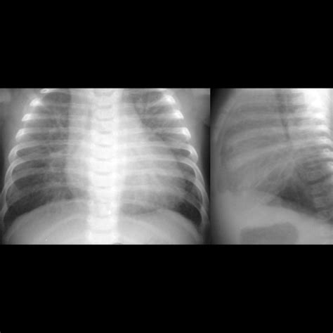Pediatric Infective Endocarditis Pediatric Radiology Reference