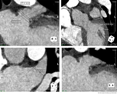 Intracardiac Echocardiography Guided Left Atrial Appendage Occlusion The Path To Independence