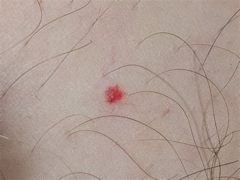 Hemangioma Icd 10 D18 Online Consultation Ai Dermatologist