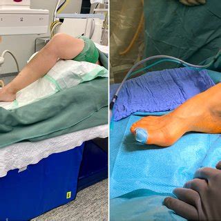 Modified Patient Positioning Using A Standard Sized C Arm Before Left Download Scientific