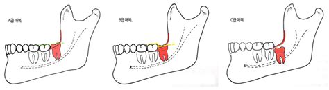 사랑니치과 서울미네르반치과