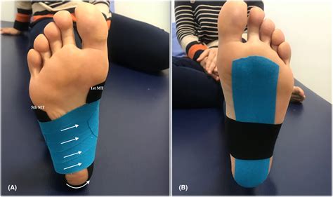 Plantar Fasciitis Taping