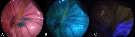 Views Of Sf Lymphography And A Misplaced Icg Injection Using The Karl Download Scientific