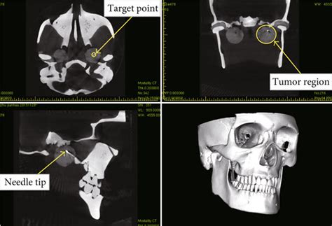 Postoperative Ct Scan Results Download Scientific Diagram