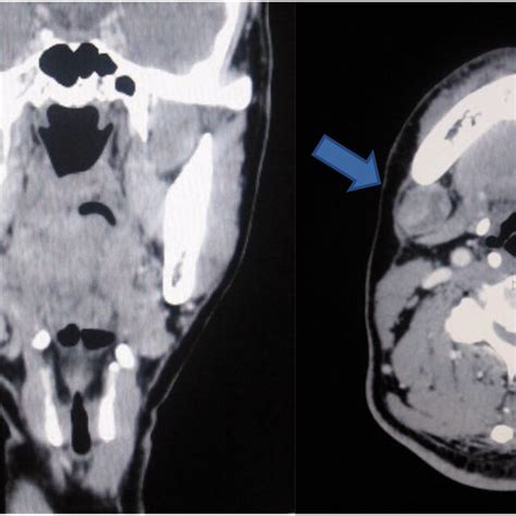 Computed Tomography Showed A 20 Mm Round And Well Defined Enhancing