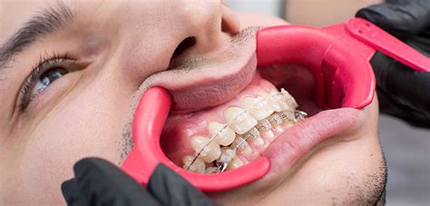How To Avoid Staining Clear Braces Stosich Consulting Avoid Staining