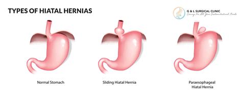Types Of Hiatal Hernia Surgery