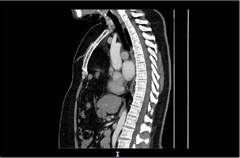 Arterial Contrast Ct Of The Chest Sagittal Slice In The Midline Of The