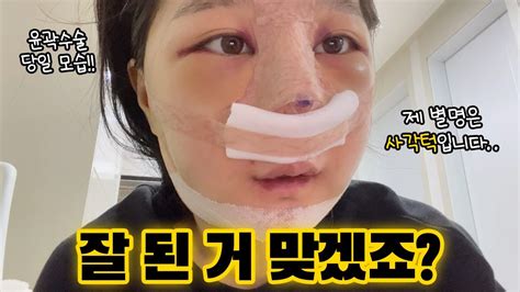 어밍밍 Vlog 심한 사각턱도 브이라인이 될 수 있다고 엥 얼굴이 어떻게 반쪽이 돼요 윤곽3종 코성형 수술당일부터 한달차까지🎀 Youtube
