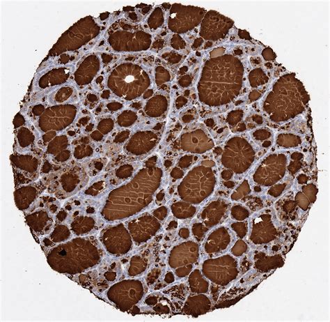 Thyroglobulin Oncodianova