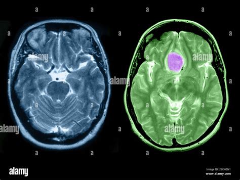 Irm De Tumeur Au Cerveau Banque De Photographies Et Dimages à Haute