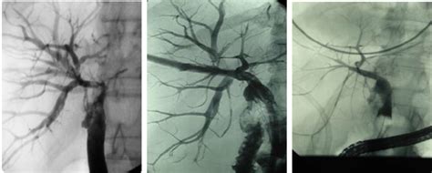 A Erc After Left Hemihepatectomy In A Patient With Itbl After Lt For Download Scientific