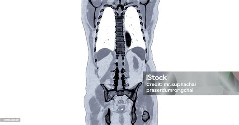 Ct 흉부 및 복부 주사 조영제 진단을 위한 관상 보기가 있는 흉부 및 복부 0명에 대한 스톡 사진 및 기타 이미지 0명