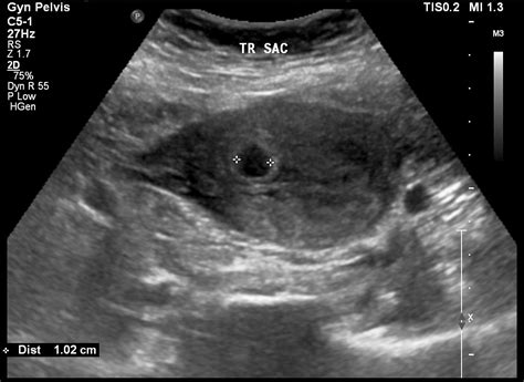Tilted Uterus And Early Ultrasound Dating Telegraph