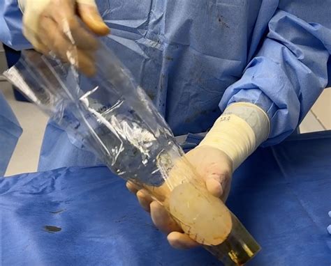 Custom Testicle Implant Insertion Technique 1 Dr Barry Eppley Explore