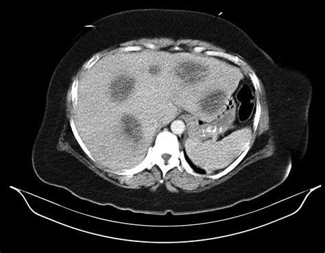 Hypercalcemia As A Presenting Clinical Manifestation Of Adenocarcinoma