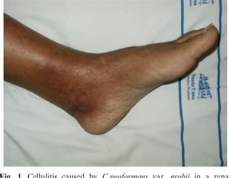 Figure 1 From Cryptococcal Cellulitis In A Renal Transplant Patient