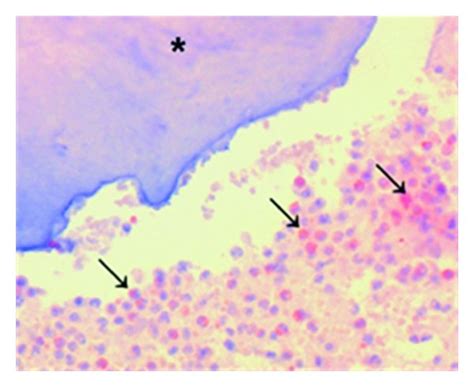 Biopsy Of A Patient With Infection And Massive Osteolysis A He