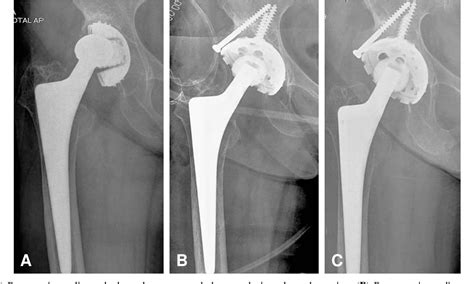 Table 1 From Revision Total Hip Arthroplasty Of An Acetabular Cup With Acetabular Bone Defects