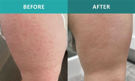 Seborrhoeic Dermatitis Legs