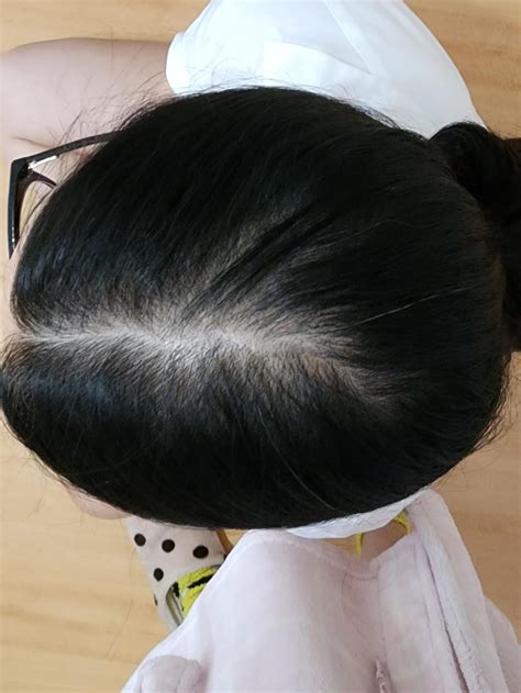 6 Months Progress Evaluation R Femalehairloss