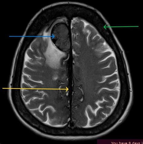 Unravelling The Enigma Of Intracranial Extramedullary Hematopoiesis A