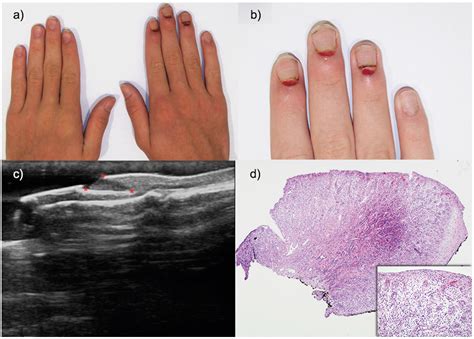 Pyogenic Granuloma Nail